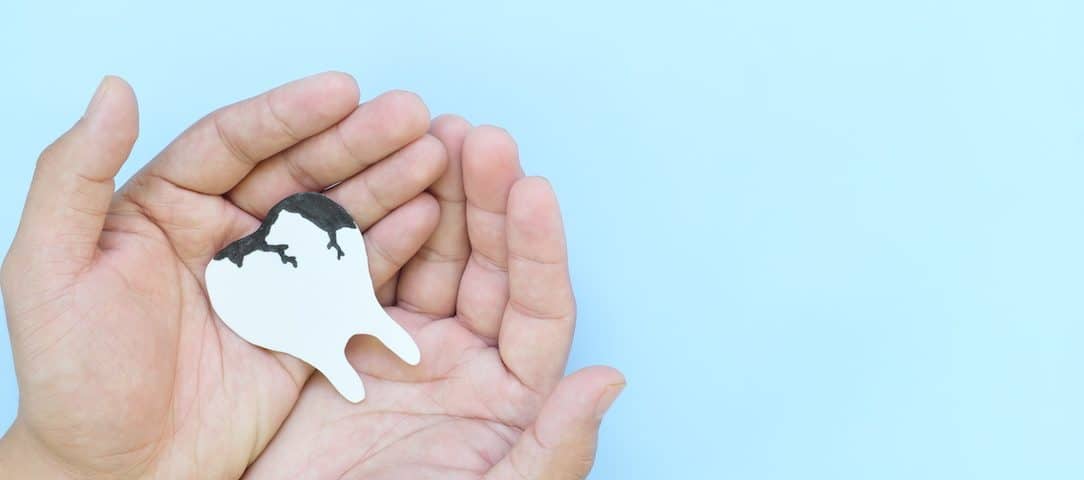 A Step-by-Step Guide to Preventing Tooth Decay