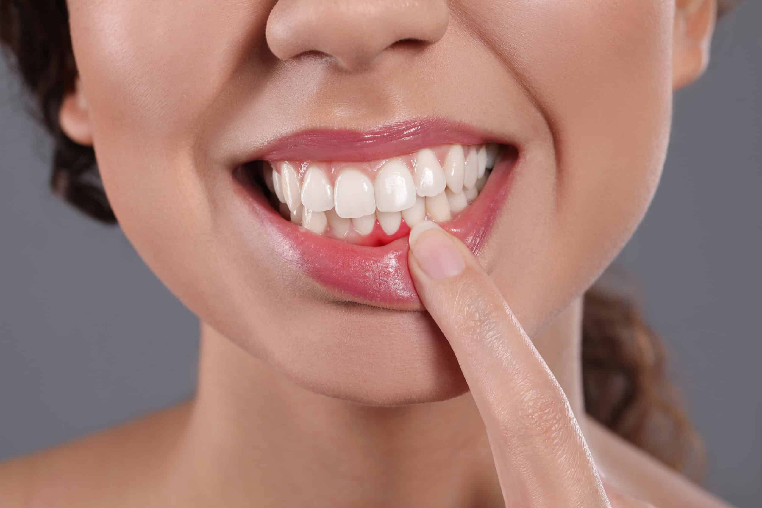 Signs of Gum Disease in Adults